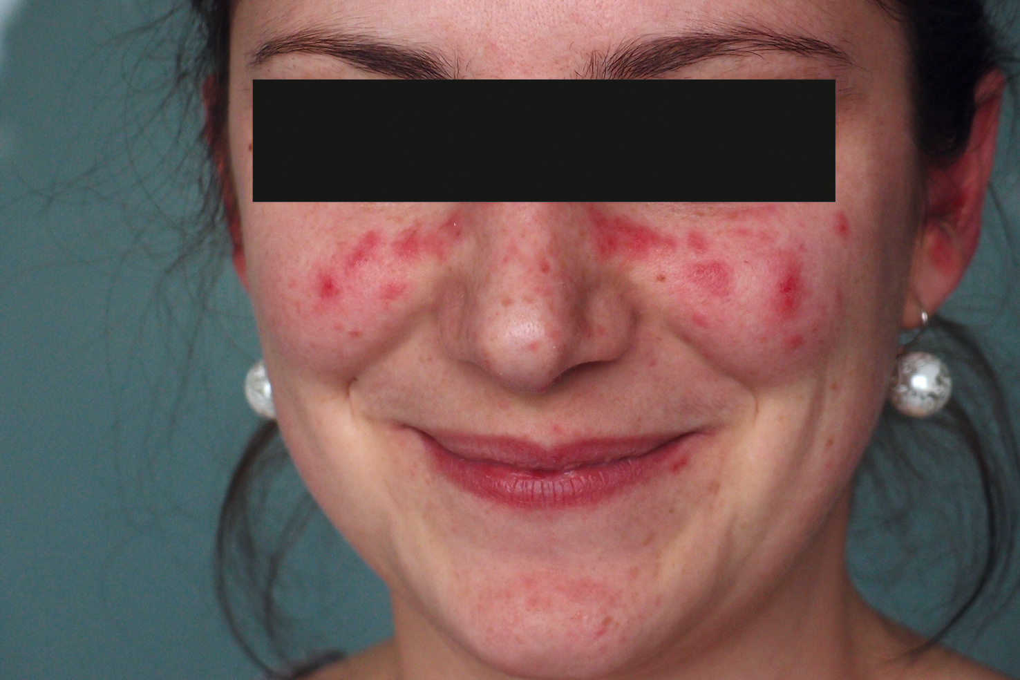 Lupus érythémateux systémique