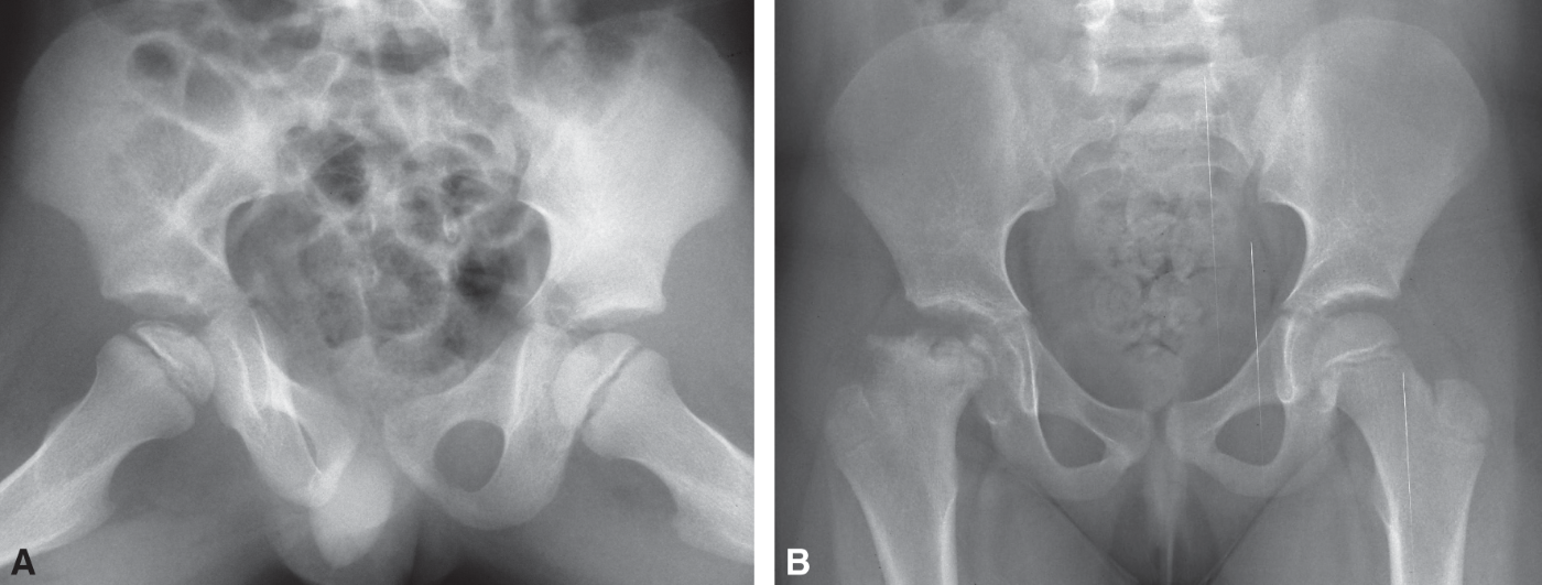 Boiterie chez l'enfant