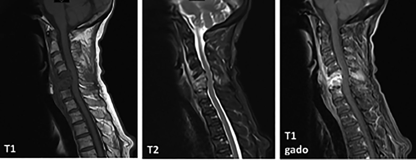 Infection ostéoarticulaire de l'enfant et de l'adulte