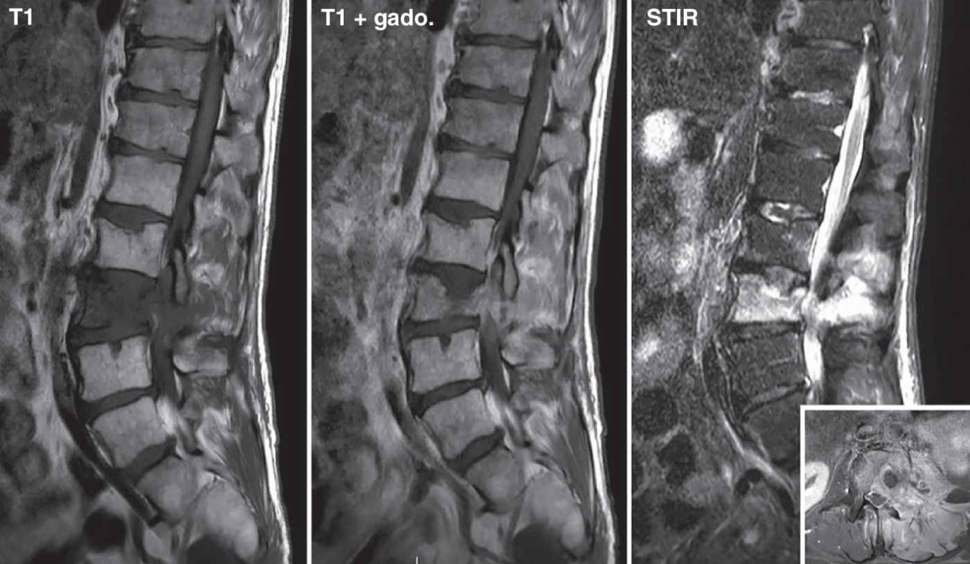 Tumeurs des os primitives et secondaires