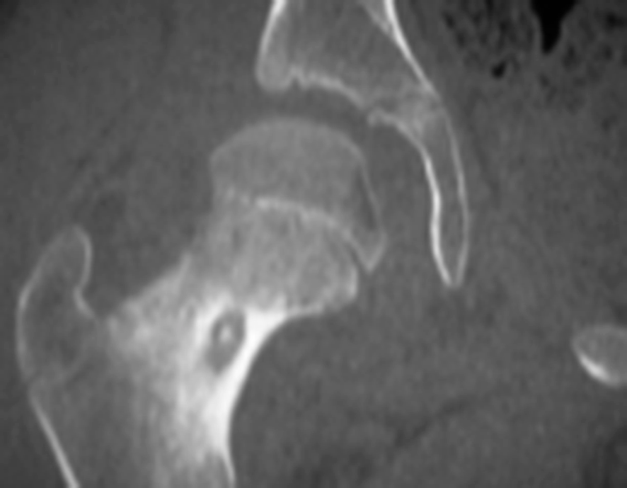 Tumeurs des os primitives et secondaires