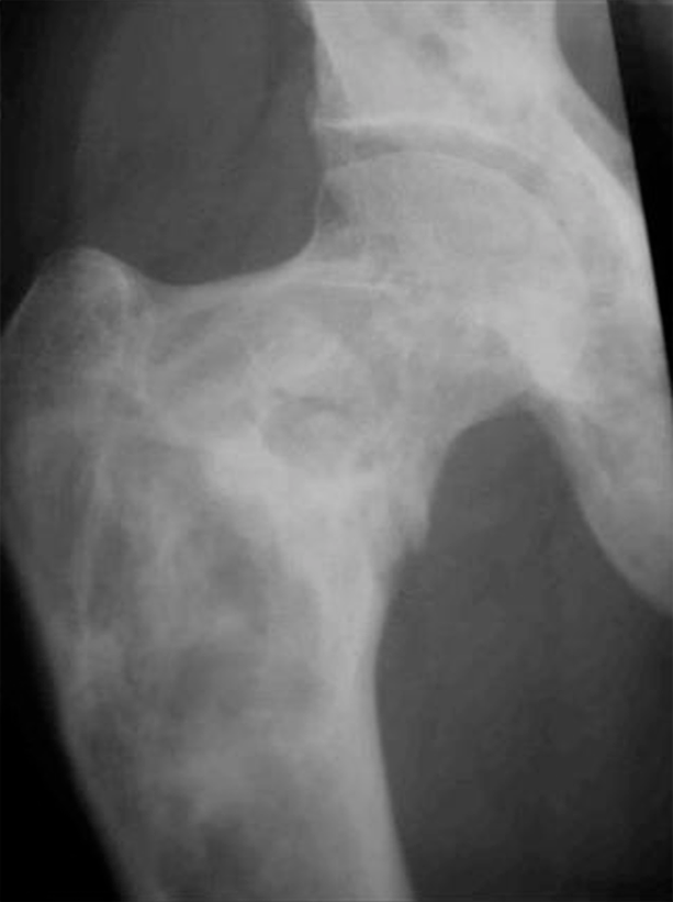 Tumeurs des os primitives et secondaires