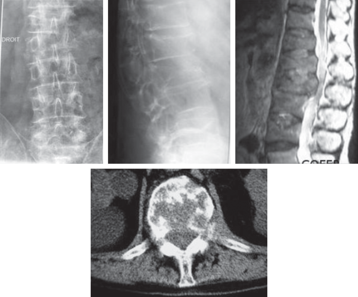 Tumeurs des os primitives et secondaires