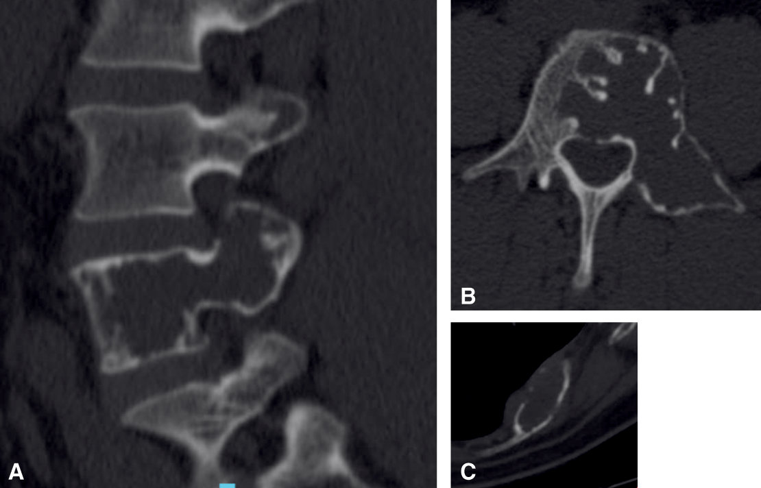 Myélome multiple des os