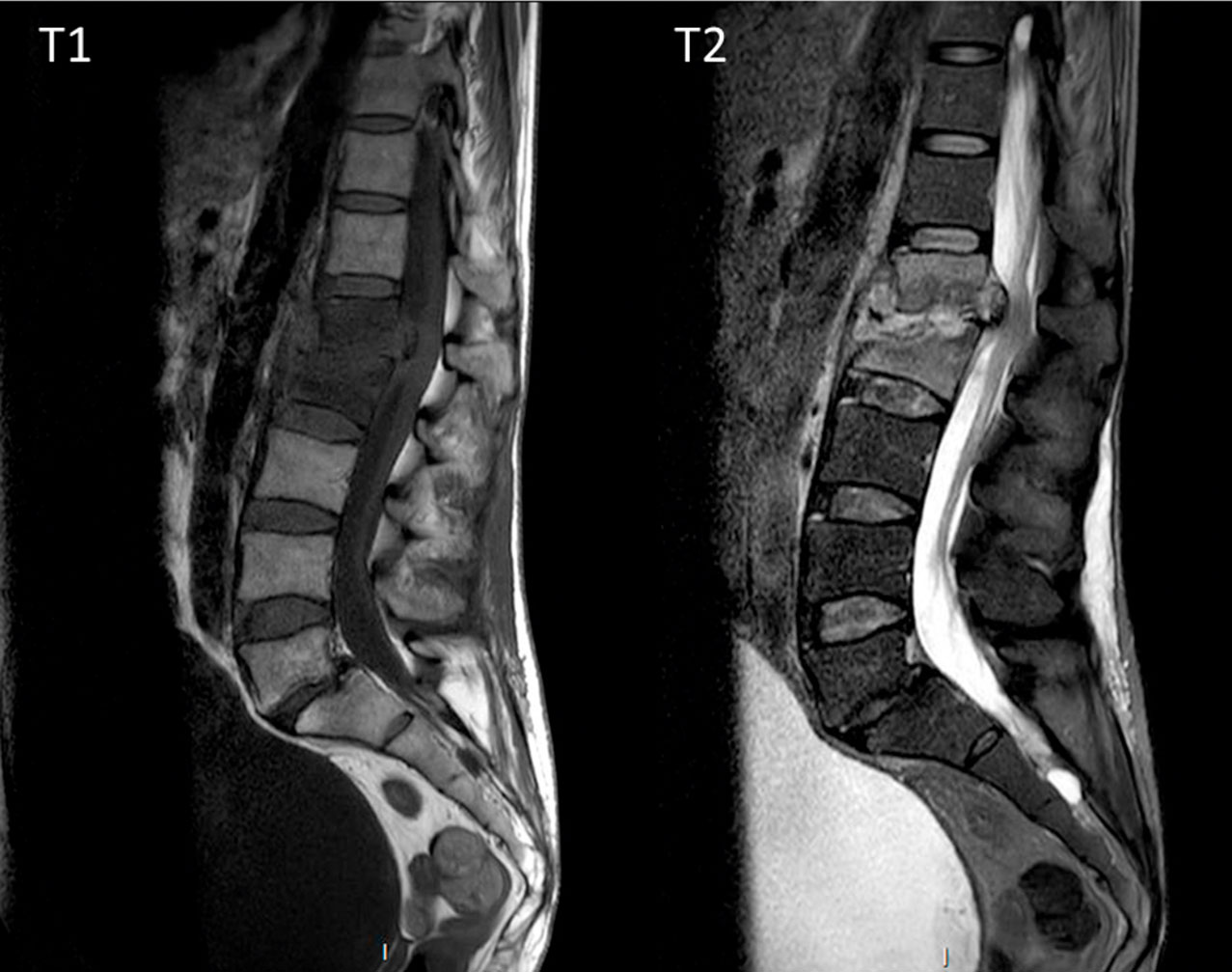 Infection ostéoarticulaire de l'enfant et de l'adulte