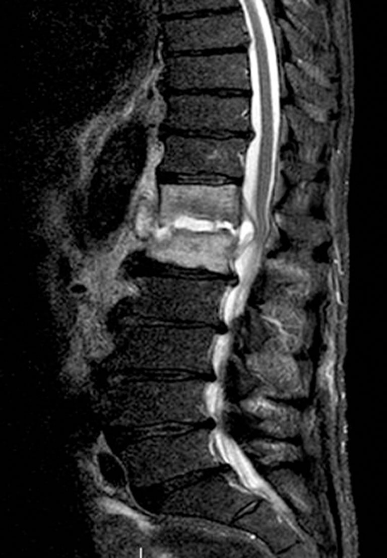 Compression médullaire non traumatique et syndrome de la queue de cheval