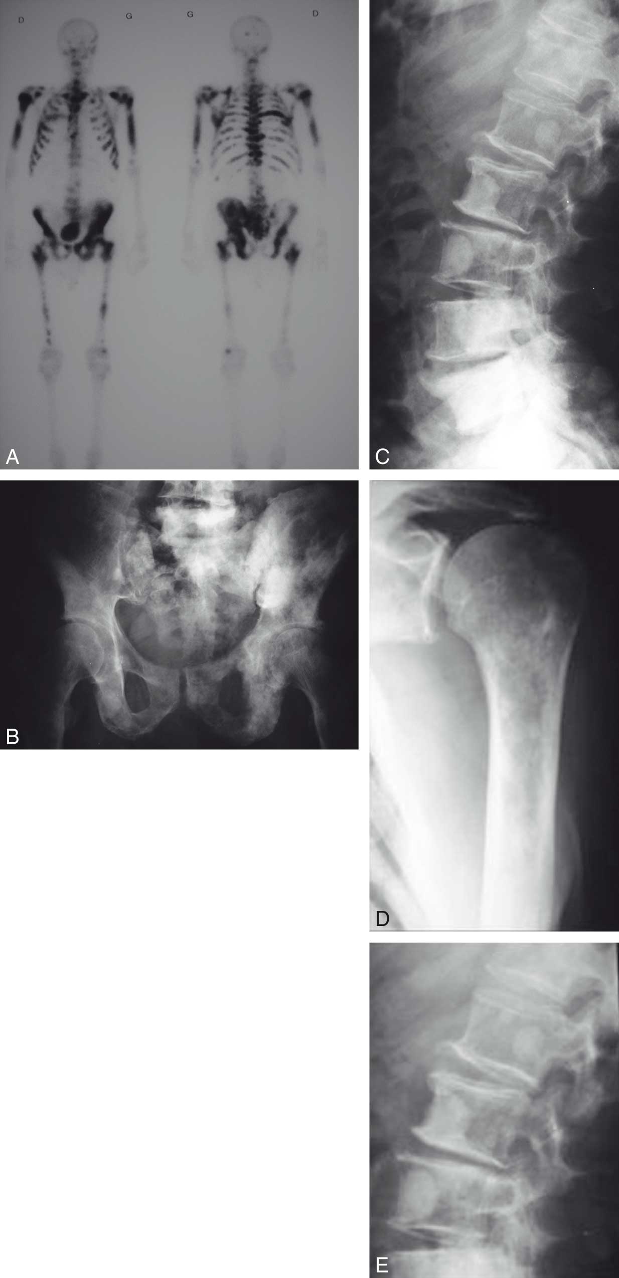 Tumeurs des os primitives et secondaires