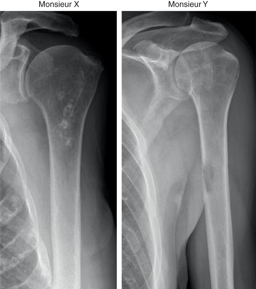 Tumeurs des os primitives et secondaires