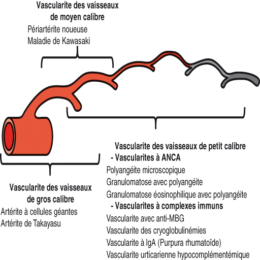 Connaître les principaux types de vascularite systémique, les organes ...