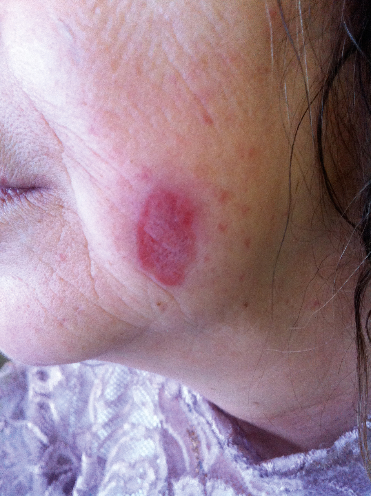 Lupus érythémateux systémique