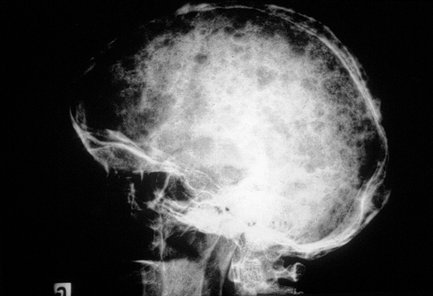 Myélome multiple des os