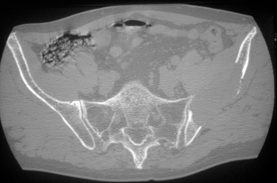 Myélome multiple des os